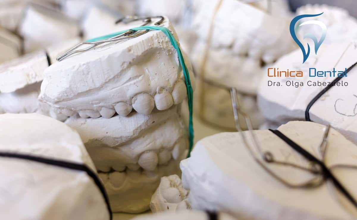 ¿Cómo se hace un molde dental y para qué sirve? | Clínica Dental Dra ...